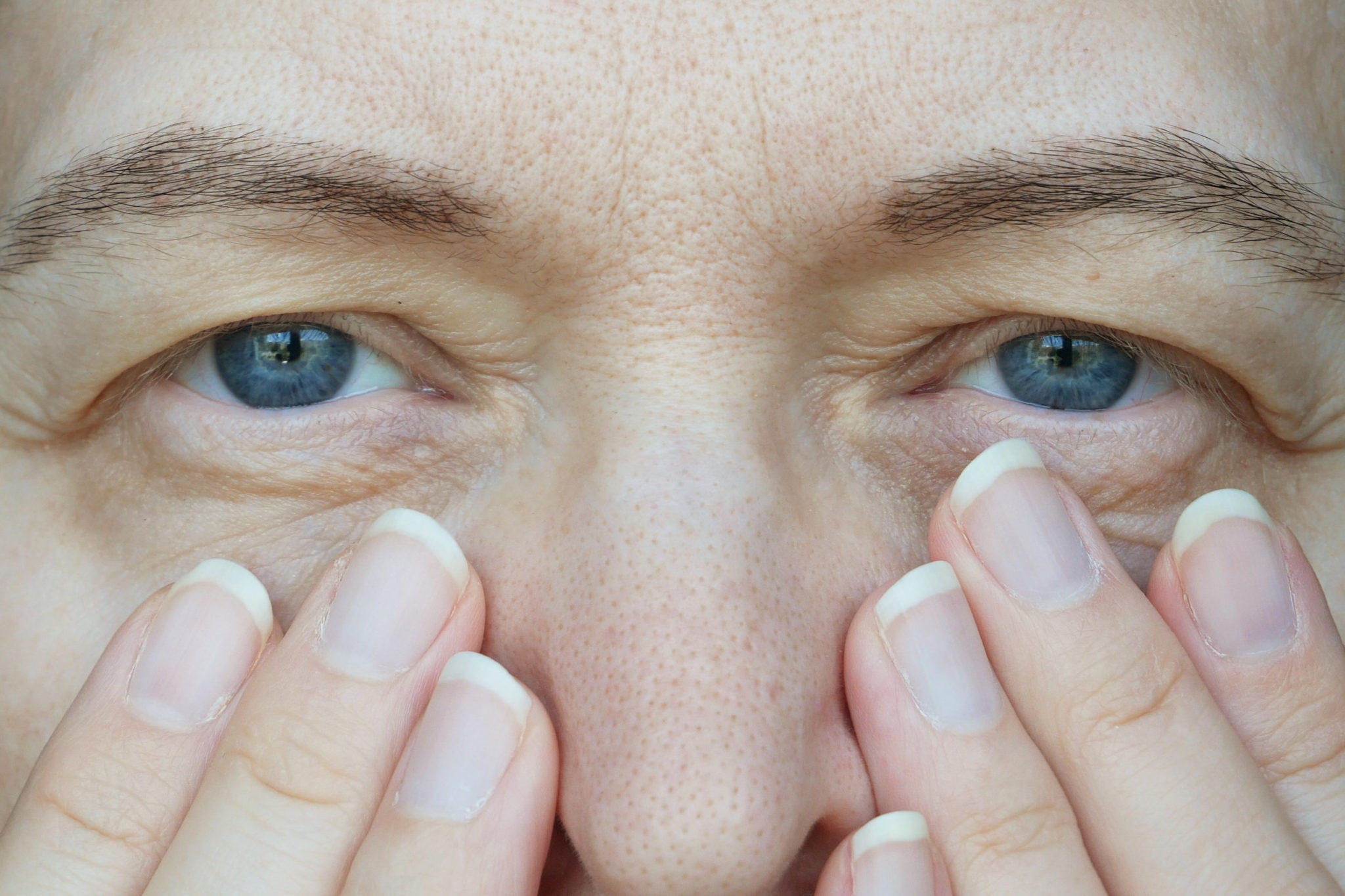 Understanding and Reversing Drooping Eyelids - J. Justin Older Understanding and Reversing Drooping Eyelids - J. Justin Older